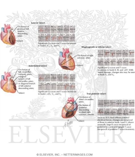 Localization Of Myocardial Infarcts