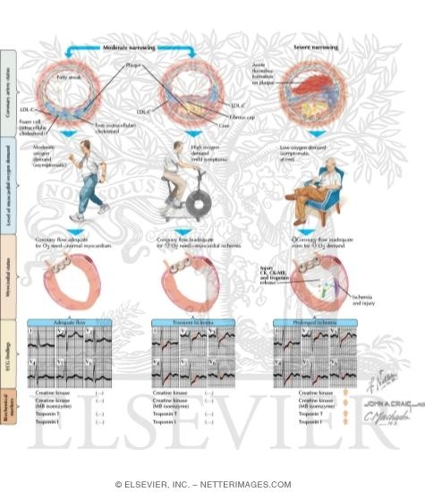 Acute Coronary Syndromes
