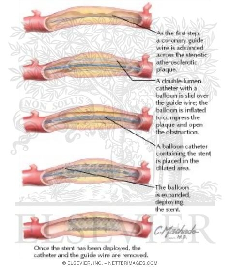 Performance of Percutaneous Coronary Intervention: Stent Deployment