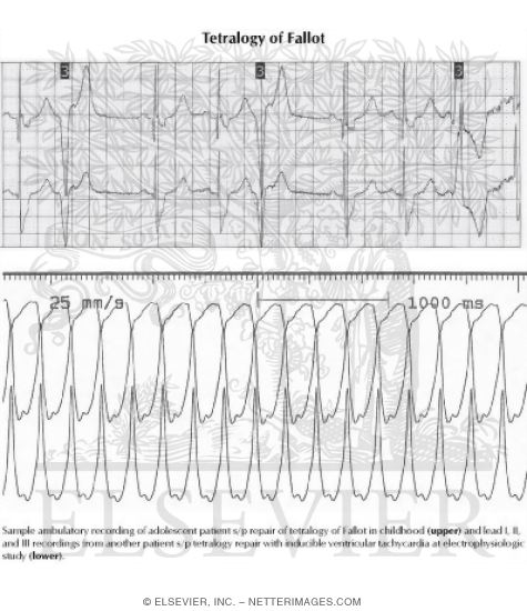 Tetralogy of Fallot