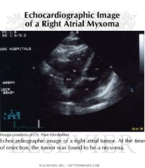 Echocardiographic Image of a Right Atrial Tumor
