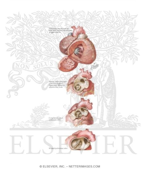 Anomalies of the Right Ventricular Outflow Tract Pulmonary Valvular ...