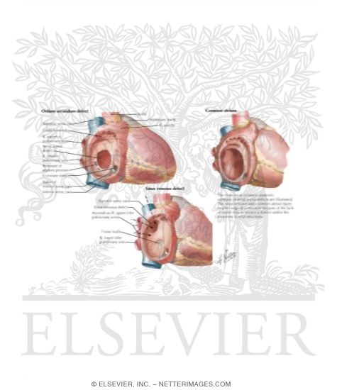 Defects of the Atrial Septum