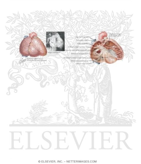Anomalies of the Tricuspid Valve Ebstein's Malformation