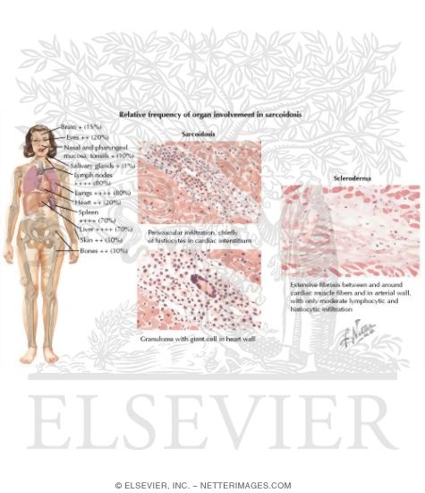 Myocarditis In Sarcoidosis and Scleroderma