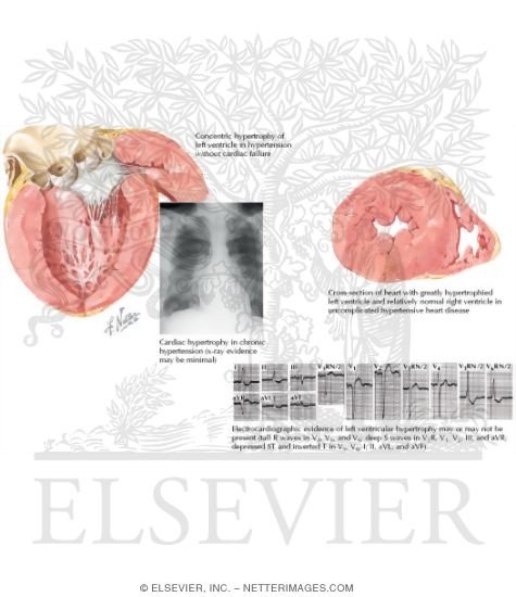 Heart Disease in Hypertension