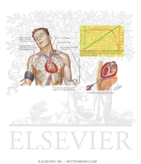 Right Atrium and Ventricle