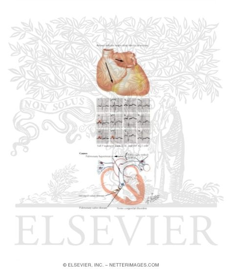 Right Atrial Enlargement