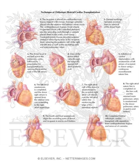 Technique of Biatrial Cardiac Transplantation