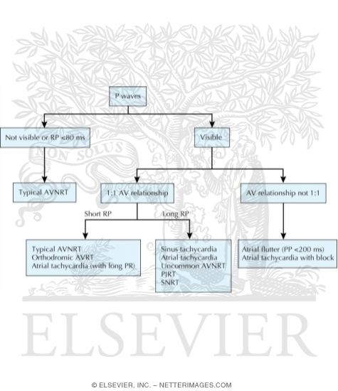 Diagnosis of Narrow-Complex Supraventricular Tachycardia