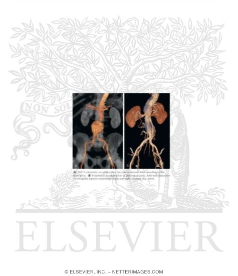 Three-dimensional (3D) CT Volumetric Reconstruction