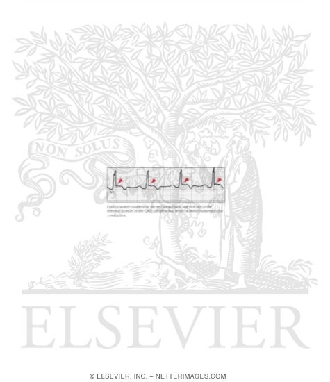 Epsilon Wave In Arrhythmogenic Right Ventricular Dysplasia Or ...
