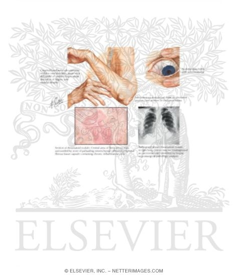 Extra-articular Manifestations in Rheumatoid Arthritis