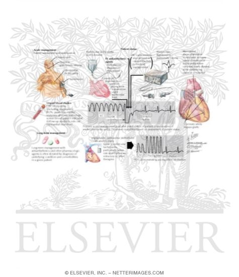 Management of Ventricular Tachycardia