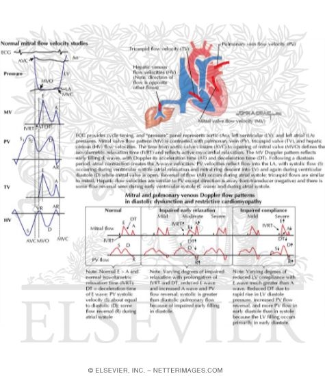 Doppler Flow Studies: Comparison of Mitral and Pulmonary Vein Flow ...