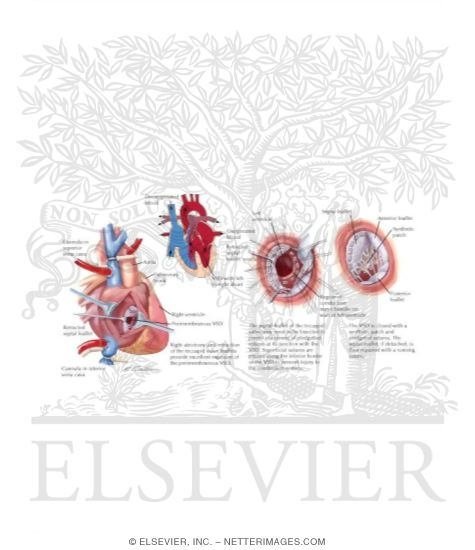Transatrial Repair of Ventricular Septal Defect (VSD)