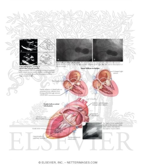 Mitral Balloon Valvuloplasty