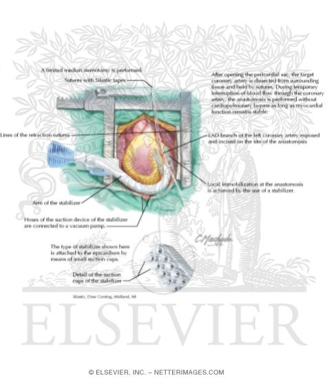 Off-Pump Coronary Artery Bypass Grafting (OPCABG)