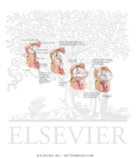 Chordal Transfer, Sliding Annuloplasty, and Ring Annuloplasty