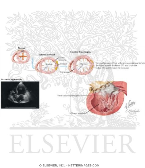 Cardiac Remodeling Secondary to Volume Overload