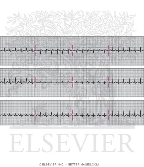 Atrioventricular Nodal Reentrant Tachycardia
