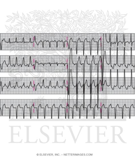 Watermarked preview of unlabeled image: Long RP Tachycardia With ...