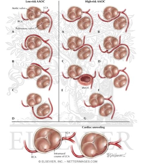 Anomalous Aortic Origin of Coronaries (AAOC)