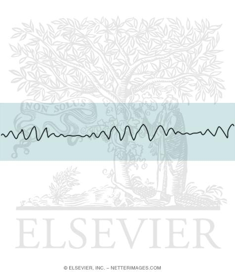Cheyne-Stokes Respiration