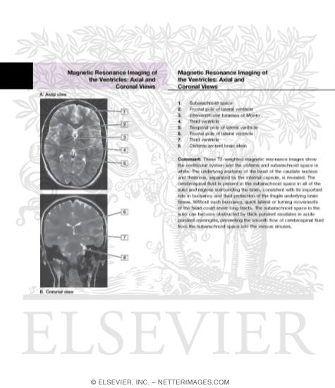 Magnetic Resonance Imaging of the Ventricles: Axial and Coronal Views