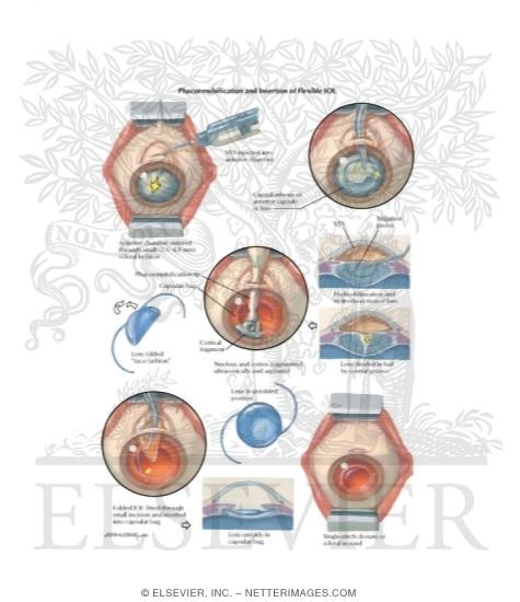 Cataracts Phacoemulsification and Insertion of Flexible IOL