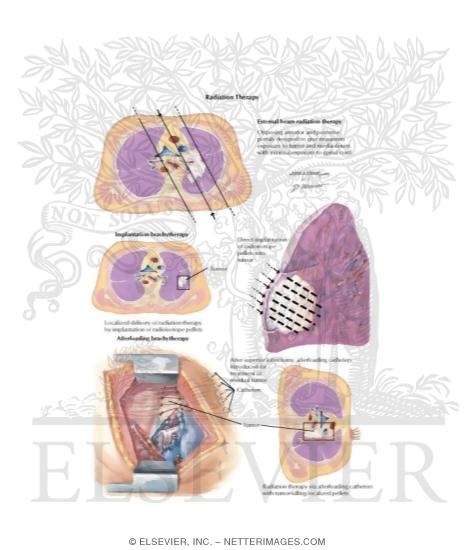 Radiation Therapy of the Lung