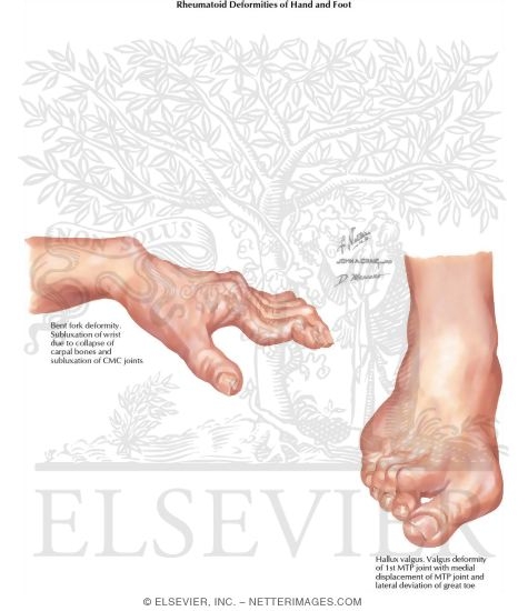 Rheumatoid Deformities of Hand and Foot