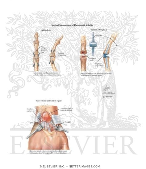 Surgical Management In Rheumatoid Arthritis
