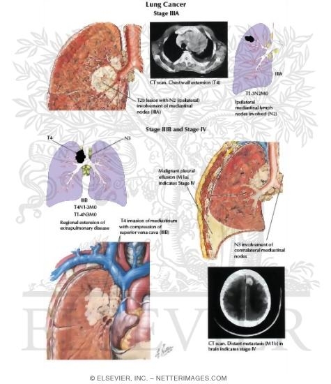 Lung Cancer (Stage IIIA and IIIB)