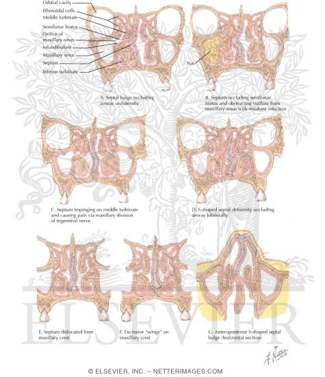Types of Deviated Septum