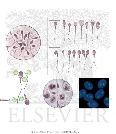 Semen Analysis and Sperm Morphology