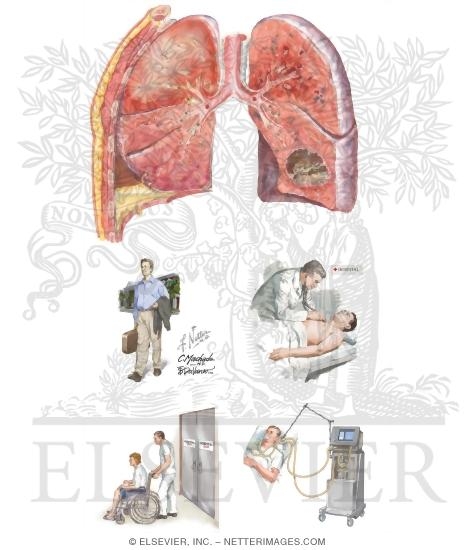 Overview of Pneumonia