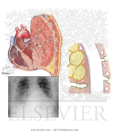 Heart Disease In Pleural Effusion