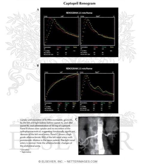 Captopril Renogram