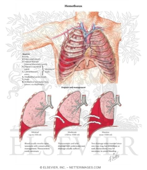 Hemothorax Sources of Hemothorax