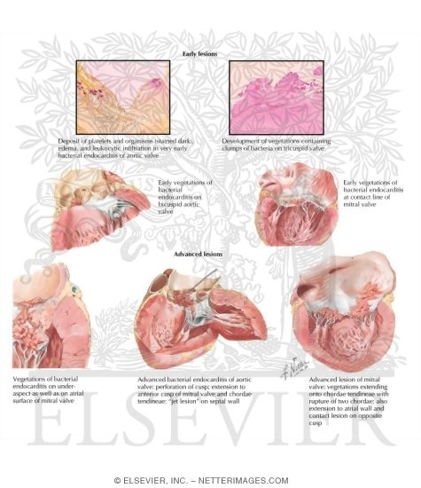 bacterial endocarditis