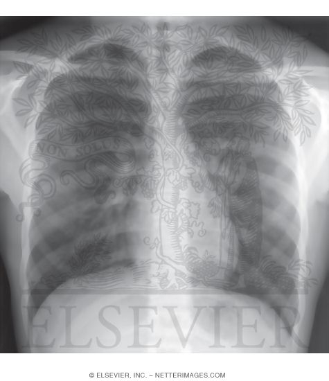 Radiograph of Chest