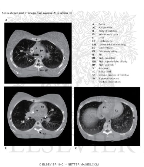Chest Scans: Axial CT Images Chest Scans: Axial CT Images