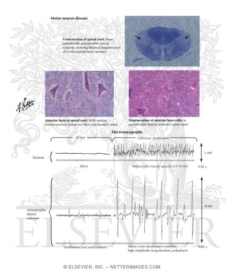 Primary Motor Neuron Disease