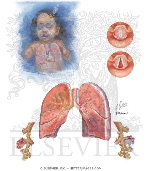 Pathophysiology of Drowning