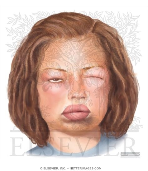 Angioedema