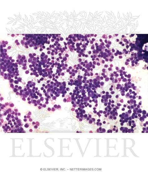 Bone Marrow Biopsy