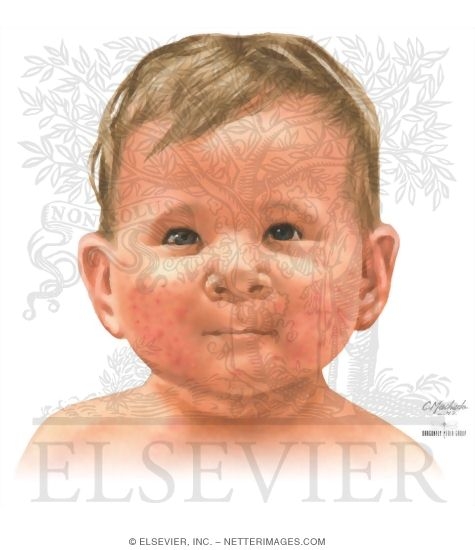 Clinical Presentation of Epstein-Barr Virus