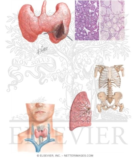 Follicular Thyroid Carcinoma