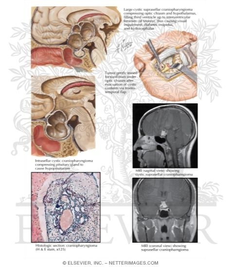 Craniopharyngiomas